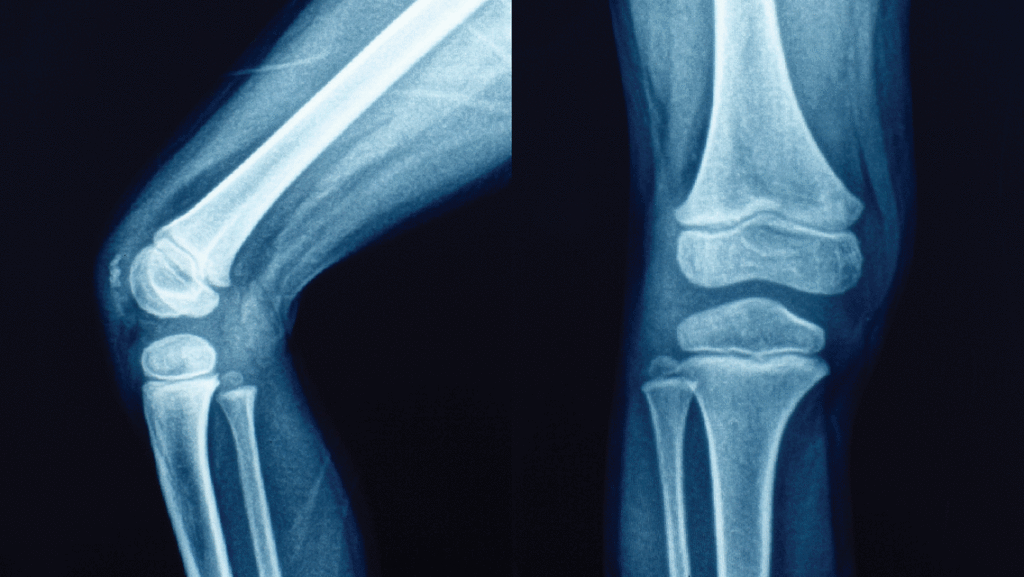 What to Eat for Healthy Joints